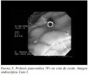 Manejo Endoscópico de Fístulas Pancreáticas: Reporte de Dos Casos